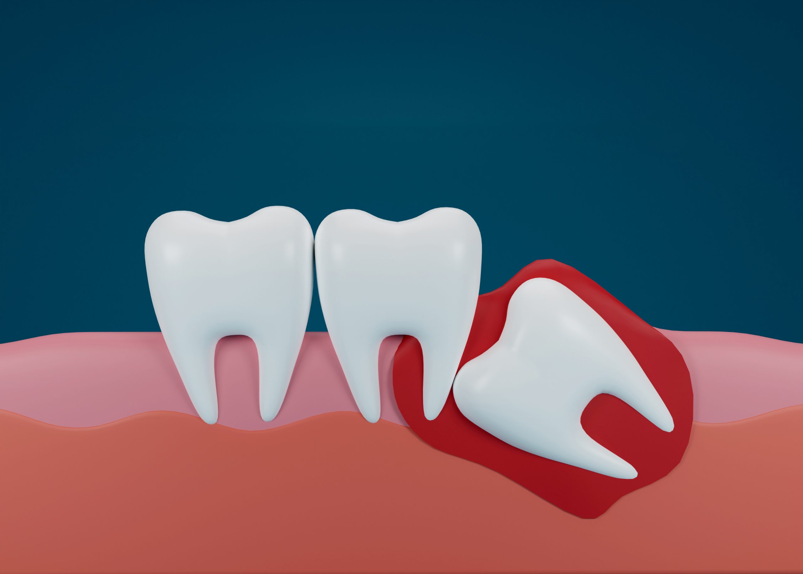 Benefits of Removing Wisdom Teeth